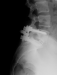 Posterior Decompression and Instrumented Fusion » Hamilton Orthopedics ...
